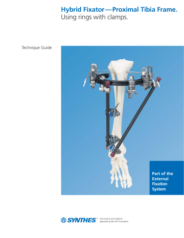 Synthes Hybrid Fixator Proximal Tibia Frame Technique Manual | Manualzz