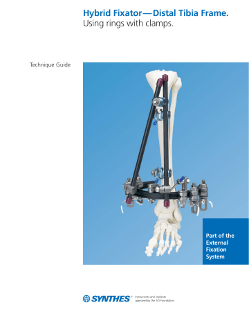 Synthes Hybrid Fixator Technique Manual | Manualzz